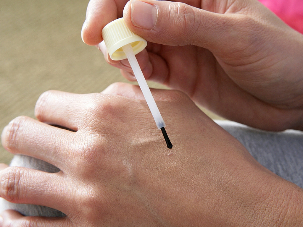 Cauterização - Dermatosaude - Dra Ana Lucia Pinheiro